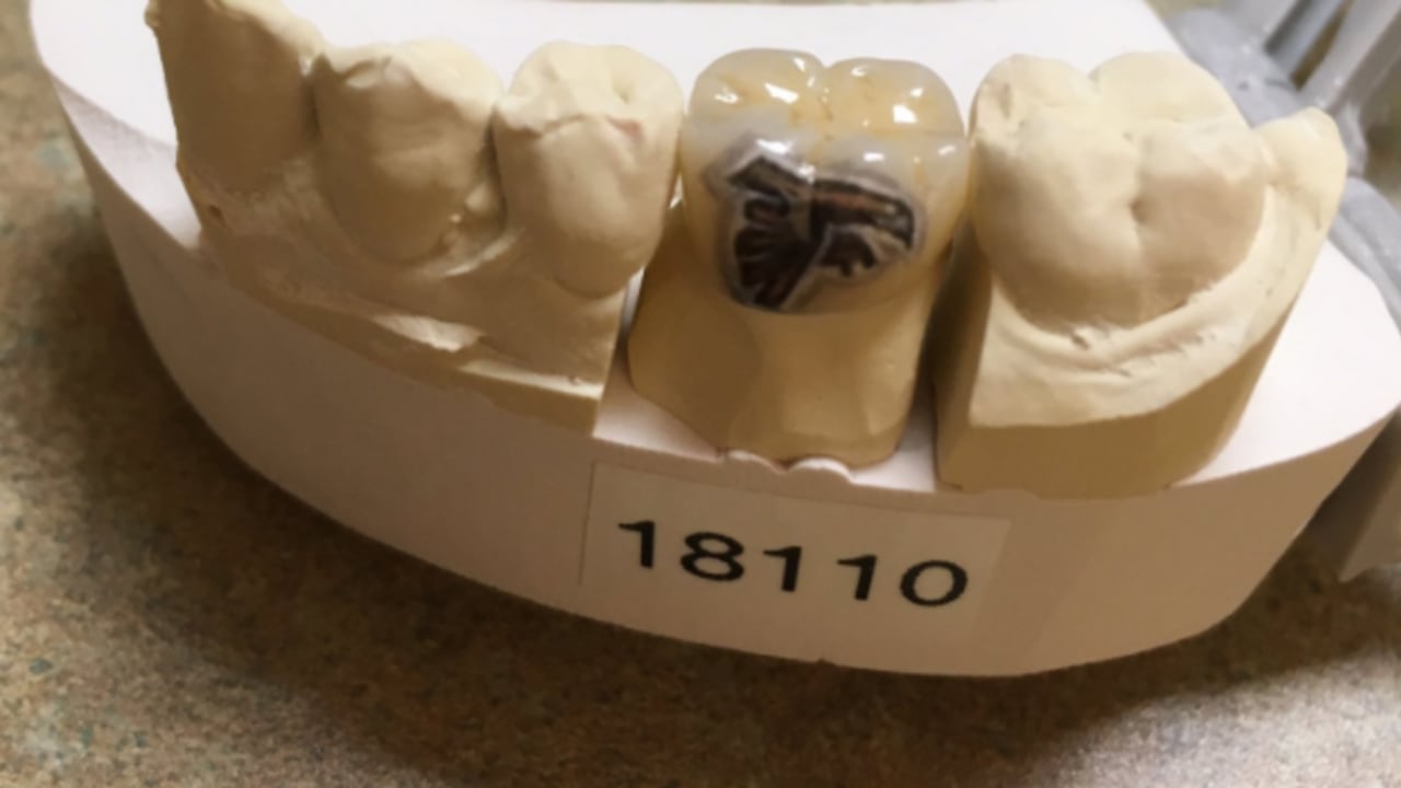 Falcons fanatic gets tooth implant with team logo